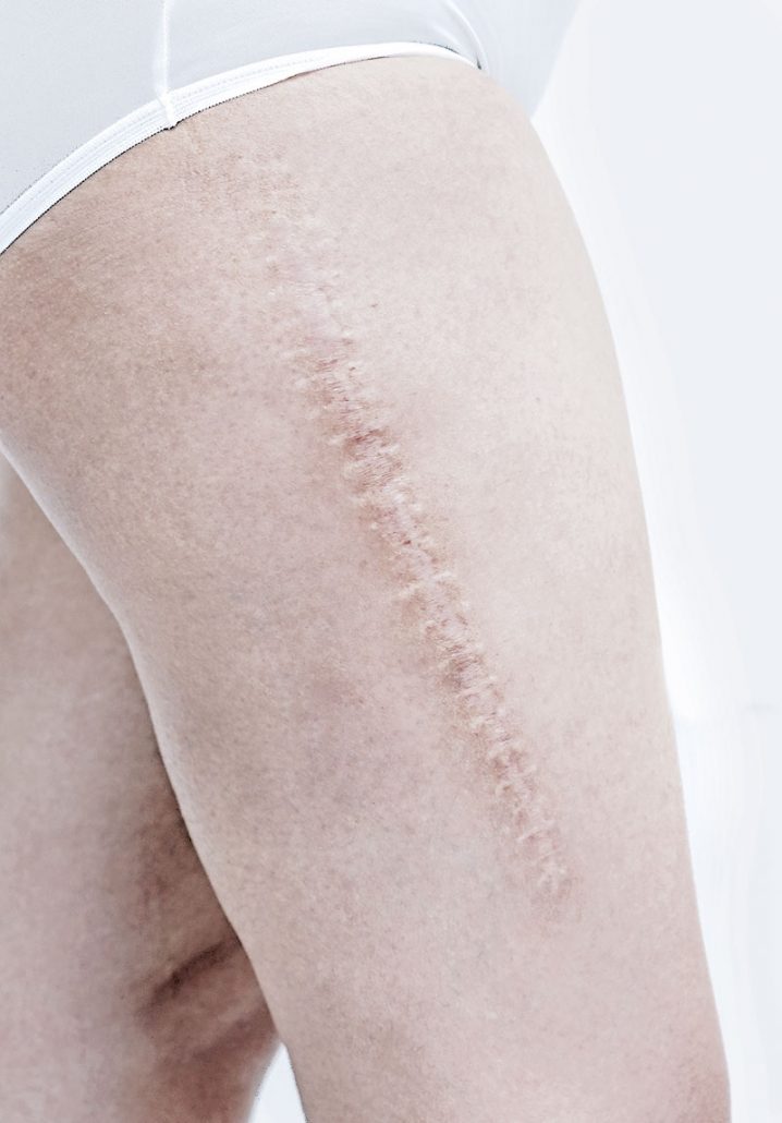 Patientenbeispiele für die Narbentherapie ScaRemedy